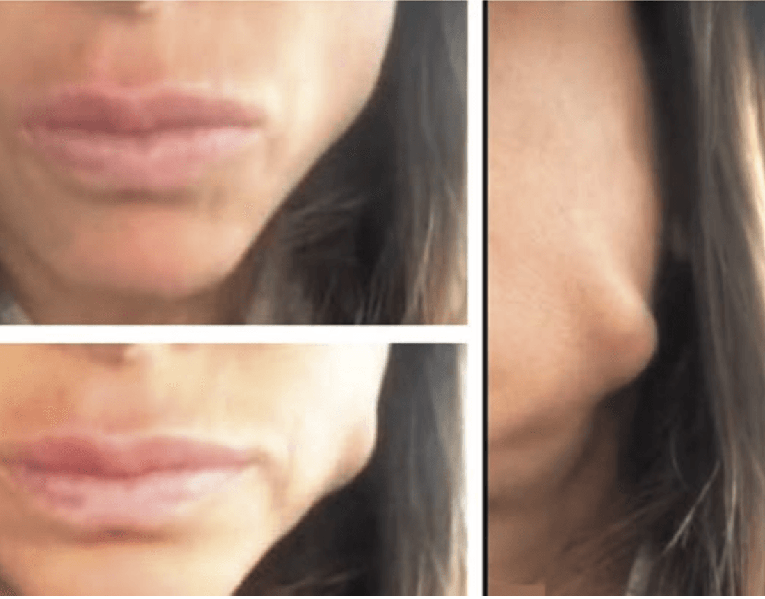 Masseter Muscle Botox injections – the new clinical protocol