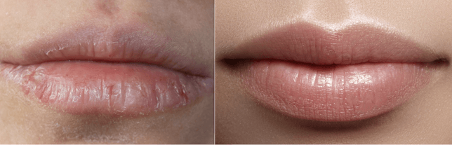 LIPS: THE FORGOTTEN ORAL TISSUE