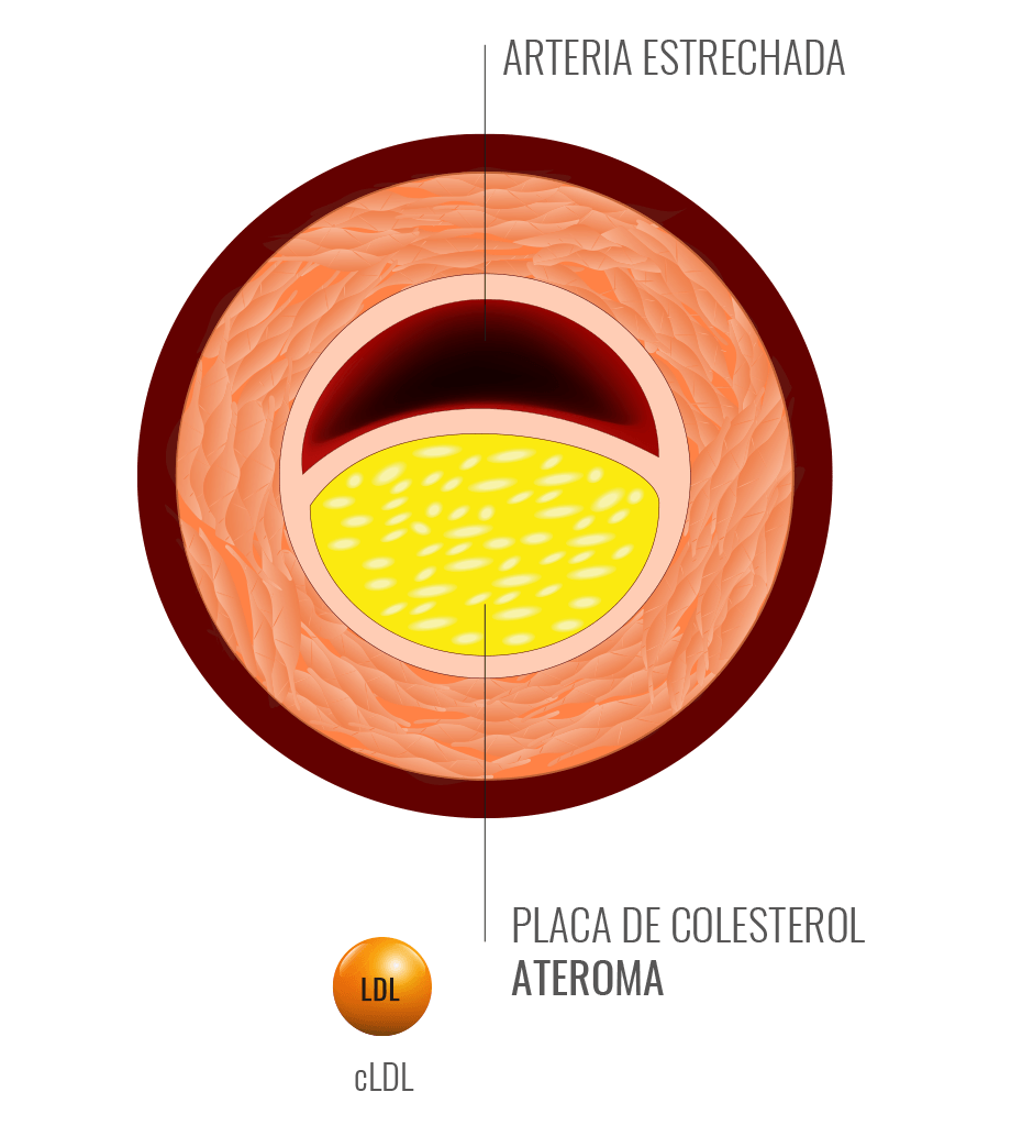LA ARTERIOSCLEROSIS