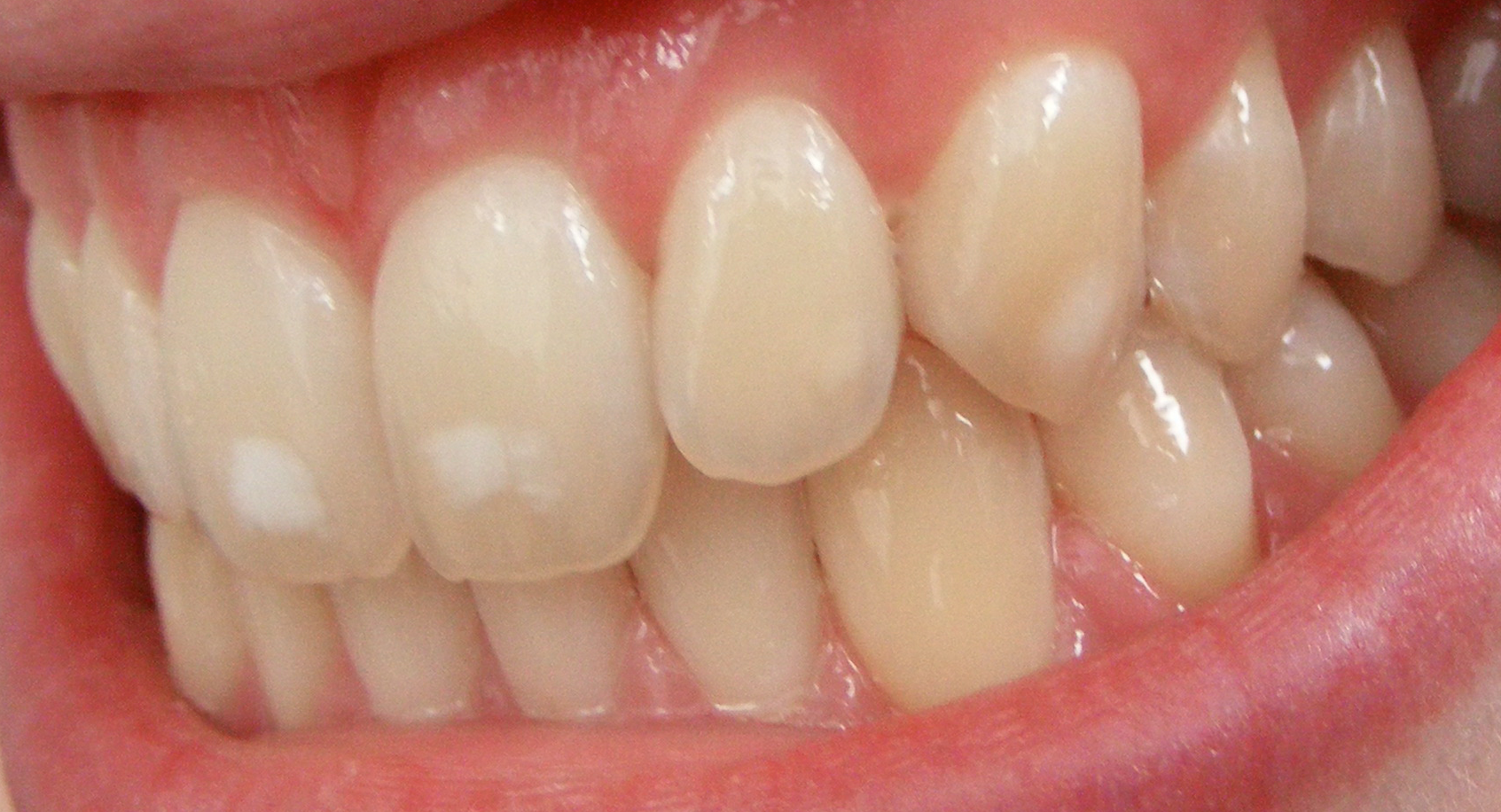 Fluorosis Fluorosis