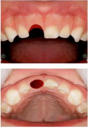 Dental Emergencies: Knowing what to do can lessen the trauma