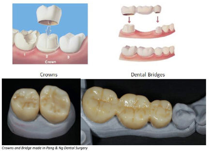 Dentures, Bridges, Crowns, Onlays, Inlays