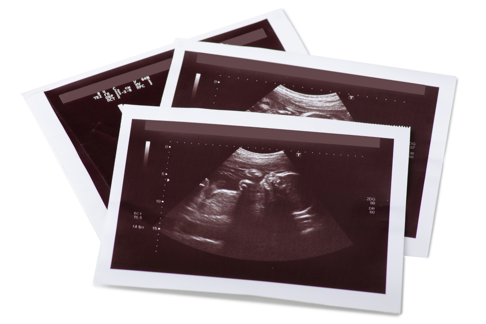 Diagnostic Ultrasound Imaging | Huntingdon Valley, PA | TRI STATE ...