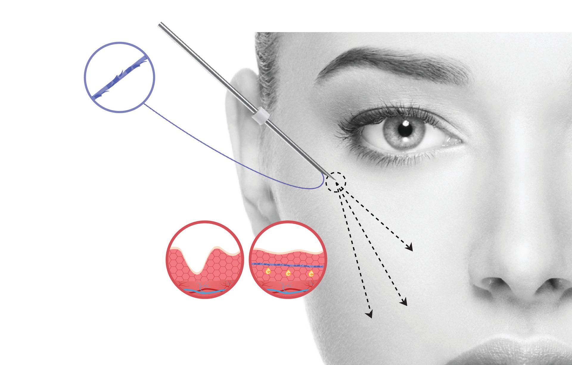 Lift, Tighten, and Rejuvenate with PDO Threads