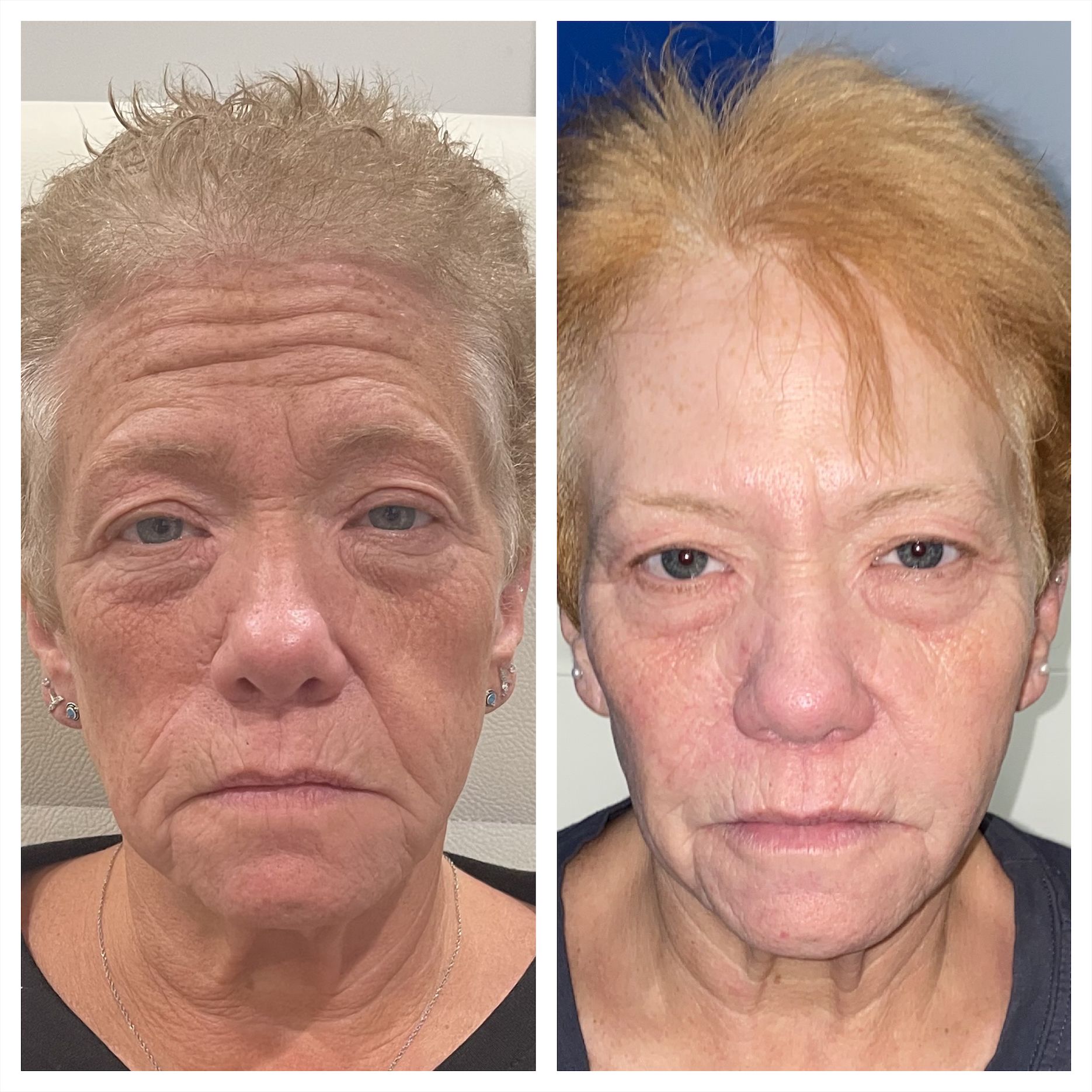 Botox & Neurotoxins in Baltimore, MD