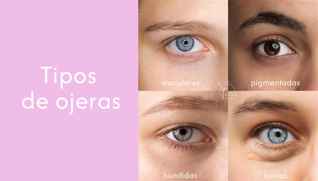 Tipos de ojeras ¿Cómo eliminarlas?