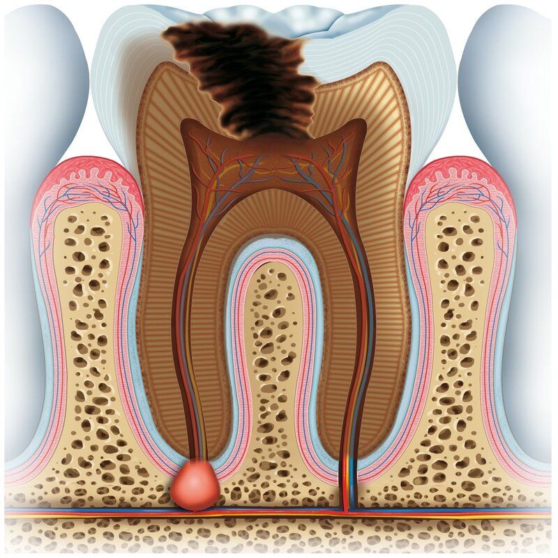 Fylling | Dental Norge