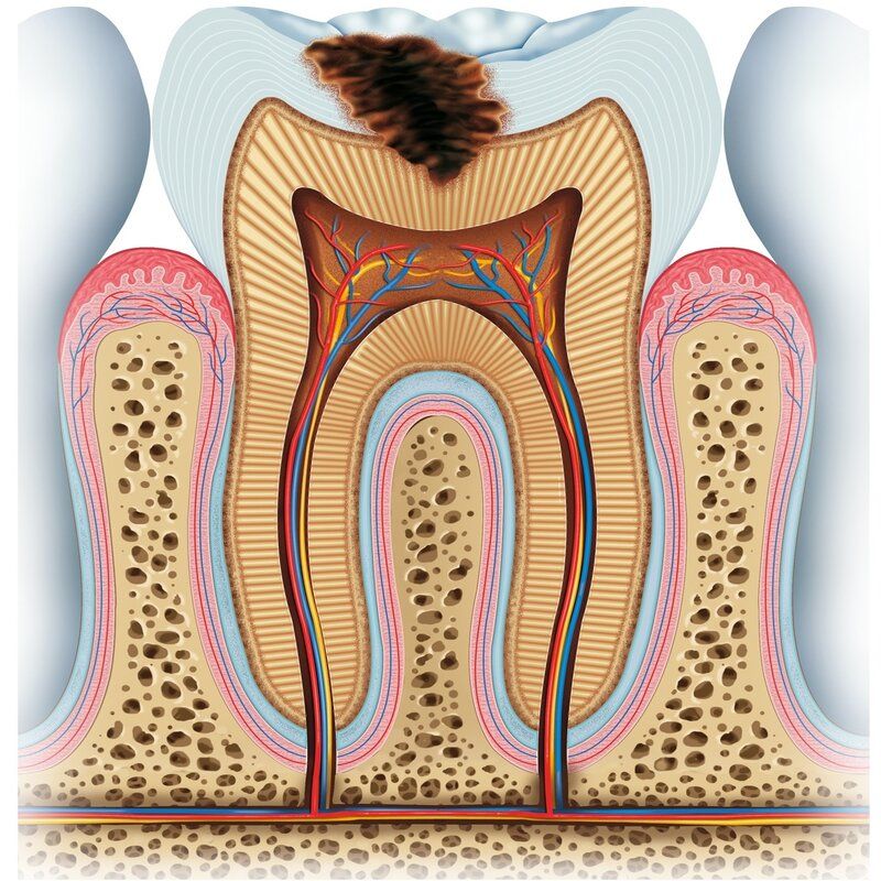 Fylling | Dental Norge