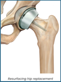 Hip Resurfacing | David Agolley Orthopaedic Surgeon