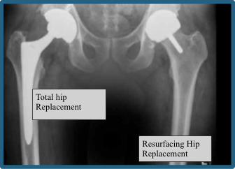 Hip Resurfacing | David Agolley Orthopaedic Surgeon