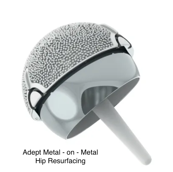 Hip Resurfacing | David Agolley Orthopaedic Surgeon