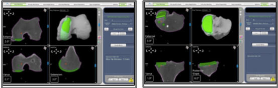 Robotic Knee Replacement | David Agolley Orthopaedic Surgeon