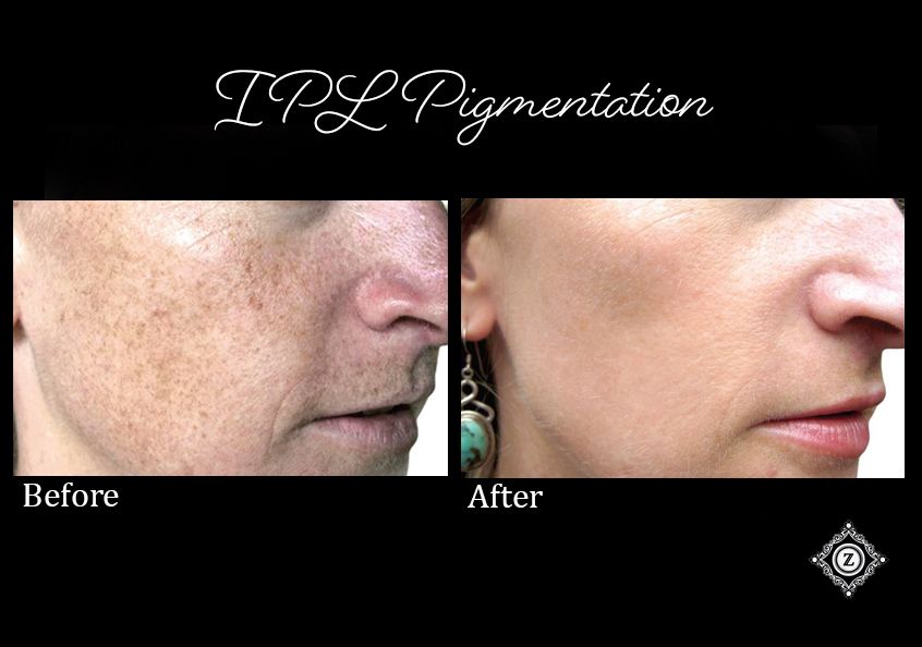 IPL Treatments | Z Aesthetic Dermatology | LA