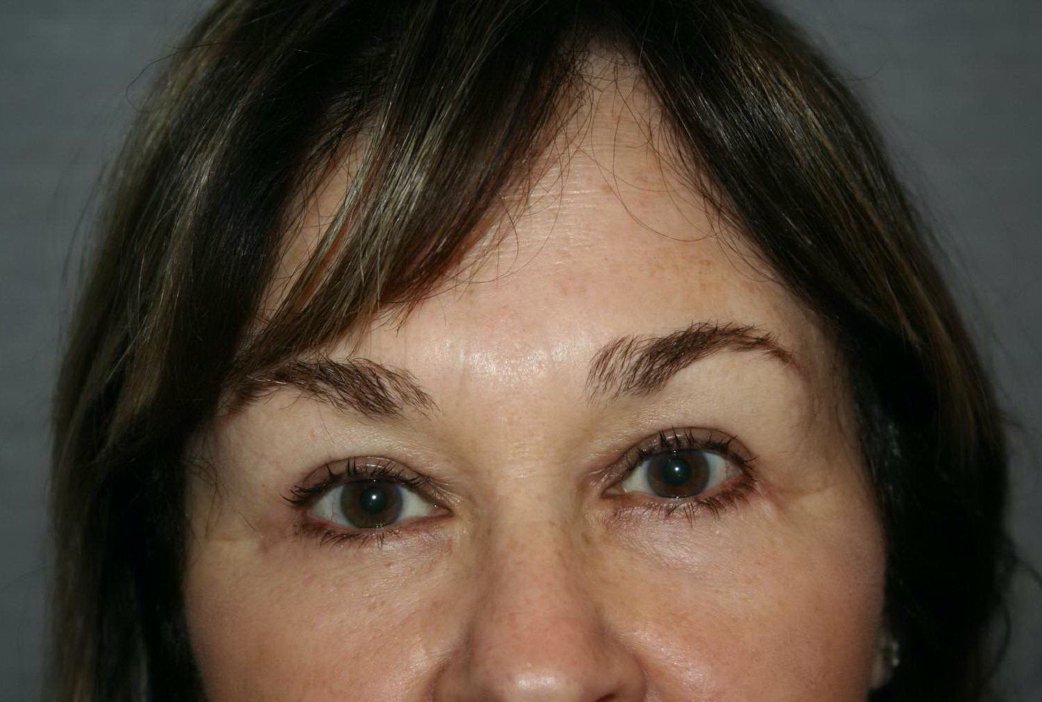 Eyelid Surgery