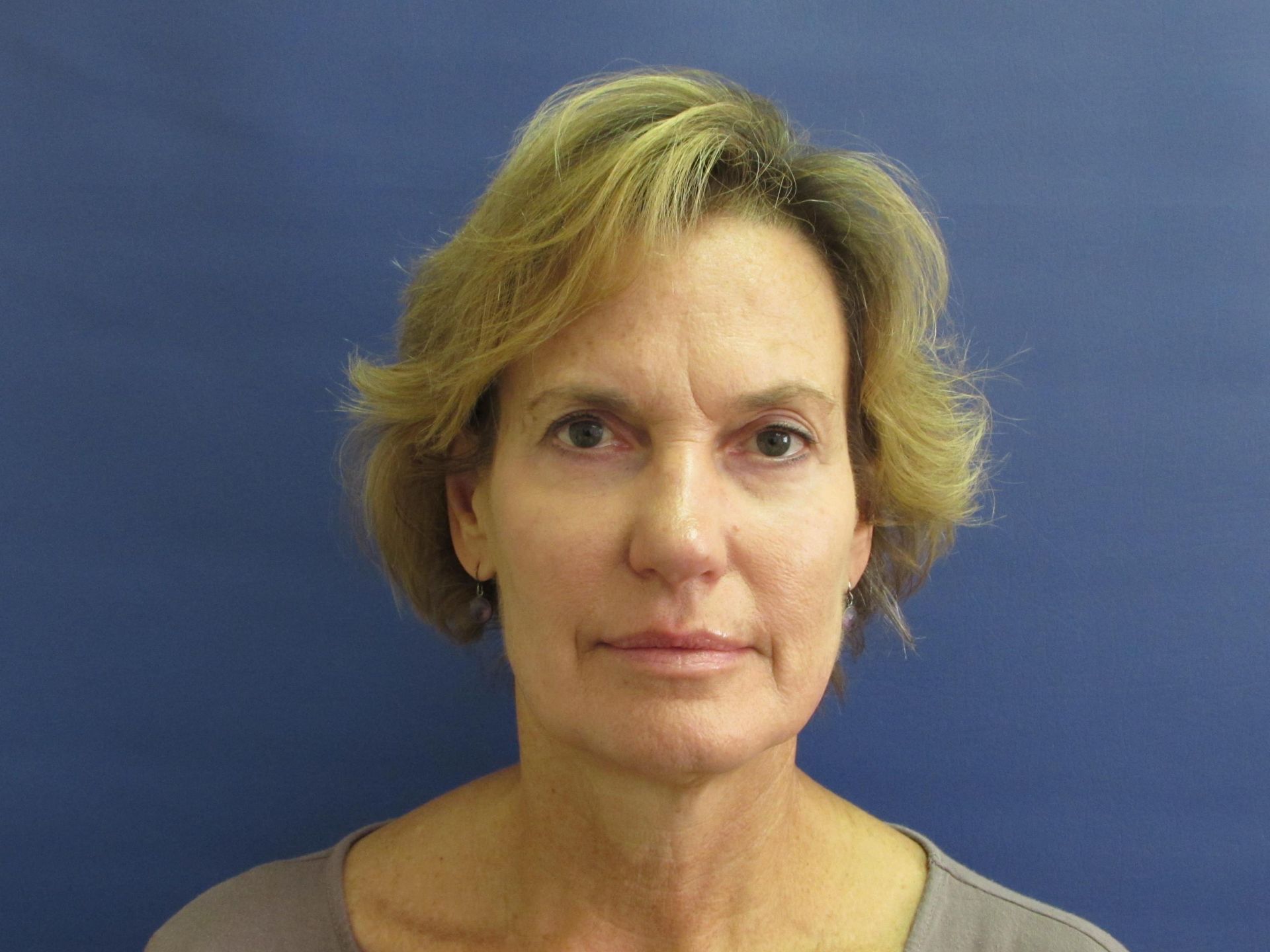 Eyelid Surgery