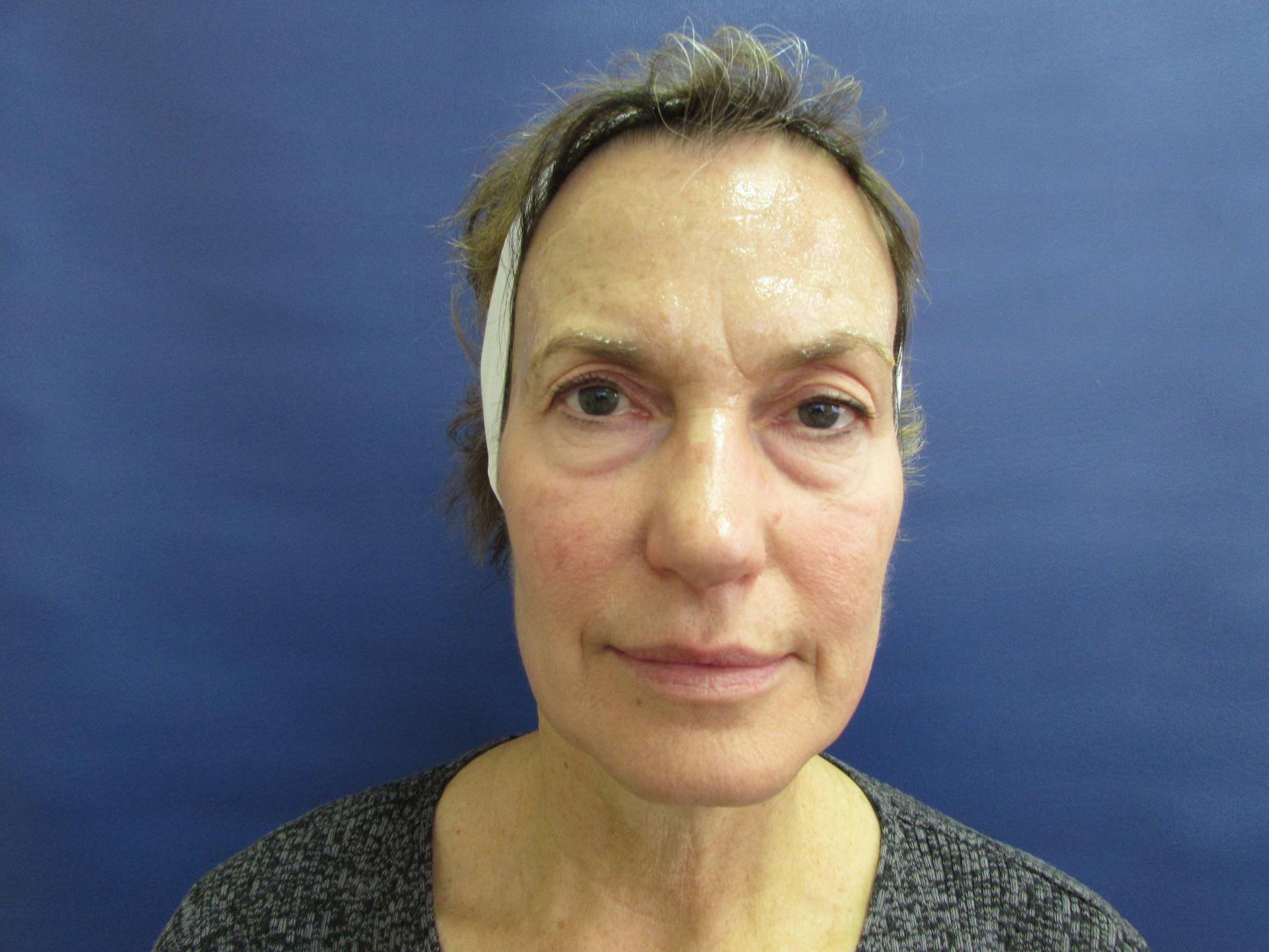 Eyelid Surgery