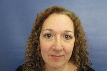Eyelid Surgery