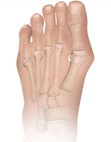Minimally Invasive Bunion Surgery - Bunbury Foot & Ankle Surgeon