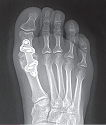 Stiff Big Toe (Hallux Rigidus) - Bunbury Foot & Ankle Surgeon