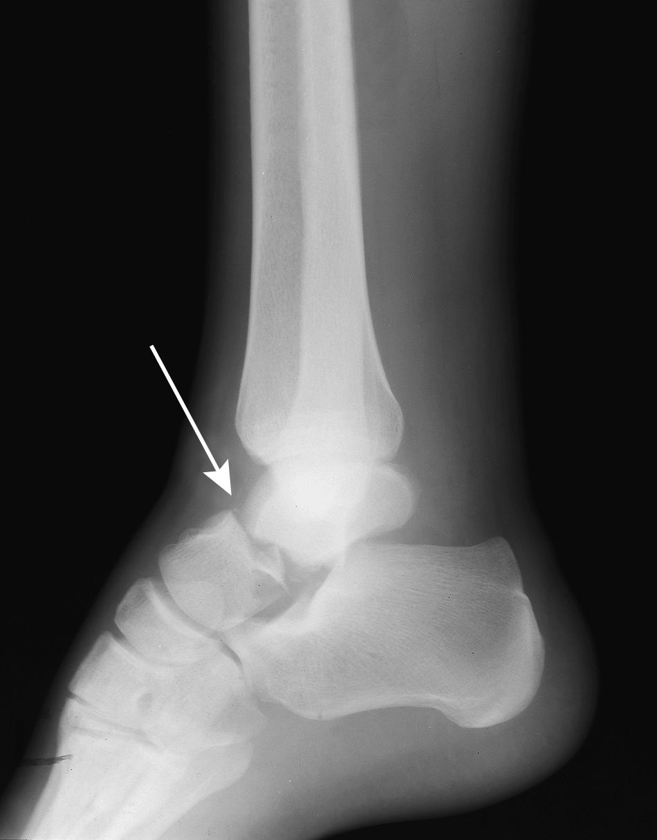 Talus Fractures - Bunbury Foot & Ankle Surgeon