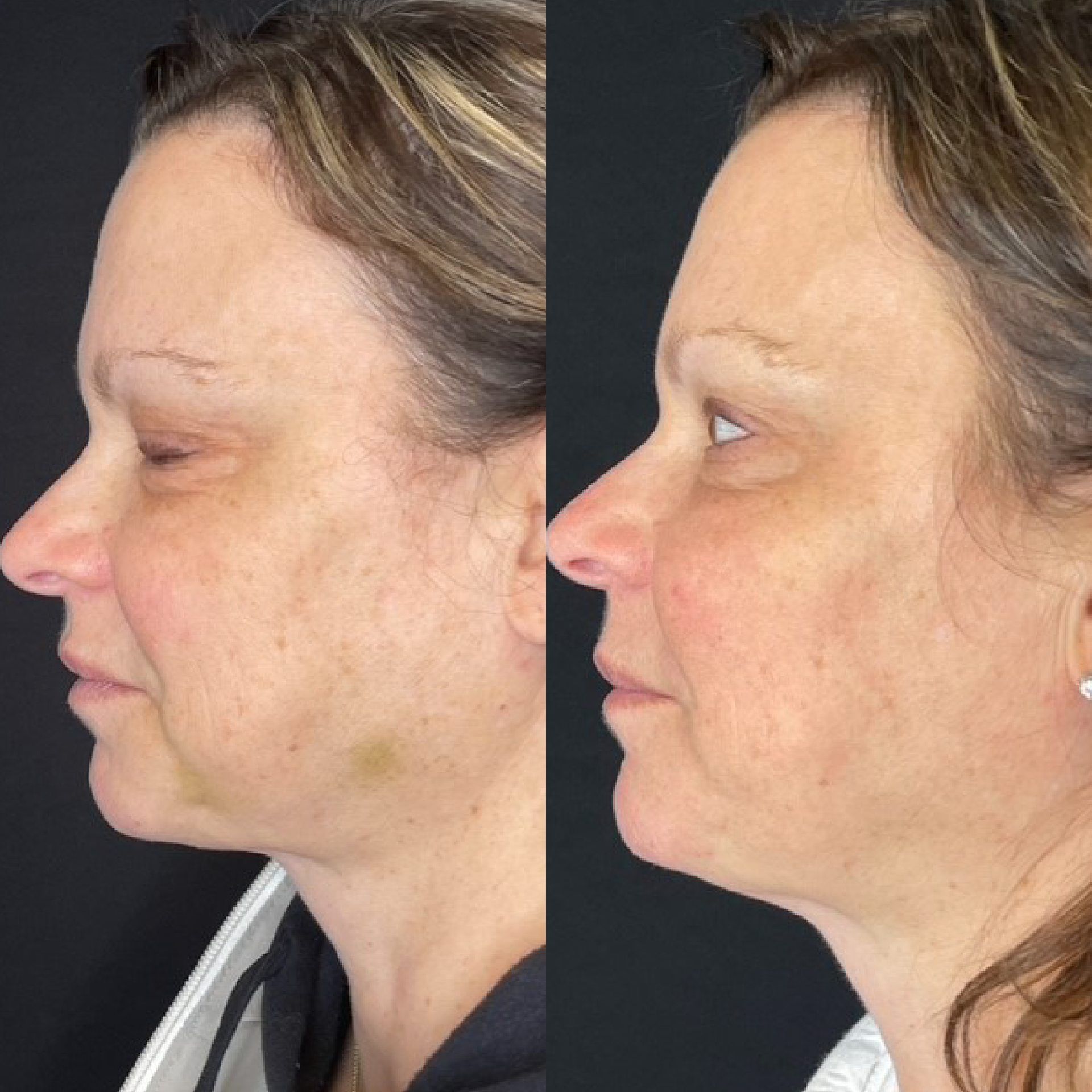 LúmEnvy™ | PDRN Brightening Skin Booster by PDO Max