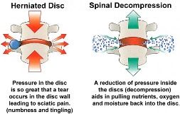 Spinal Decompression Powell OH | Be Aligned Health