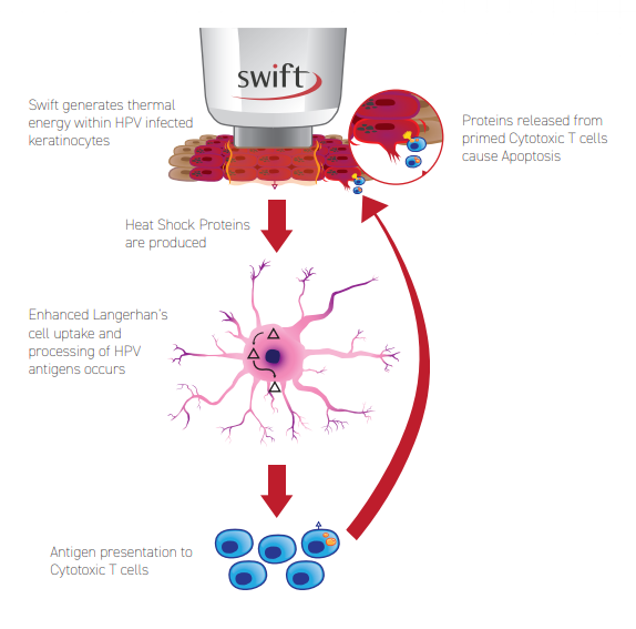 SWIFT VERRUCA TREATMENT
