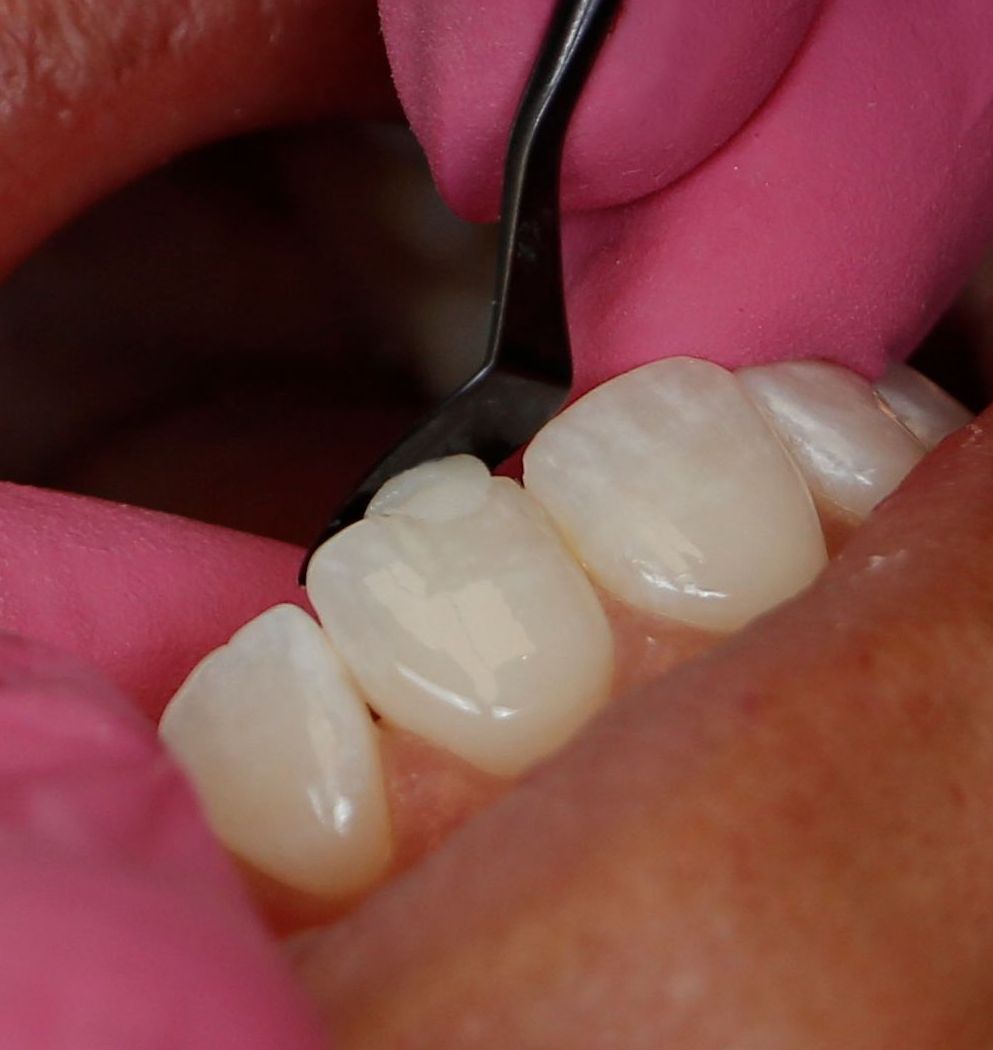 Post-Procedure Instructions | Smile Essentials | Denver