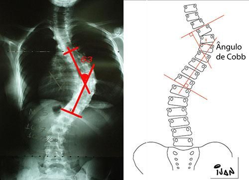 Escoliose | Dr. Ivan Rocha