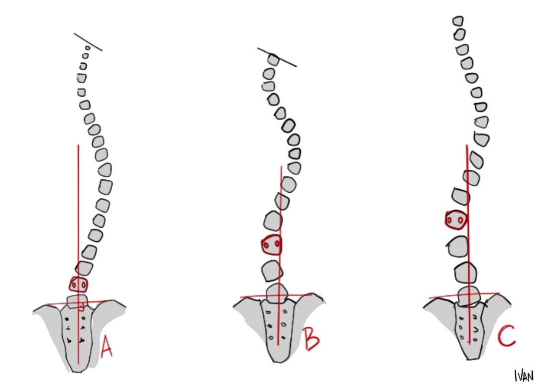 Escoliose | Dr. Ivan Rocha