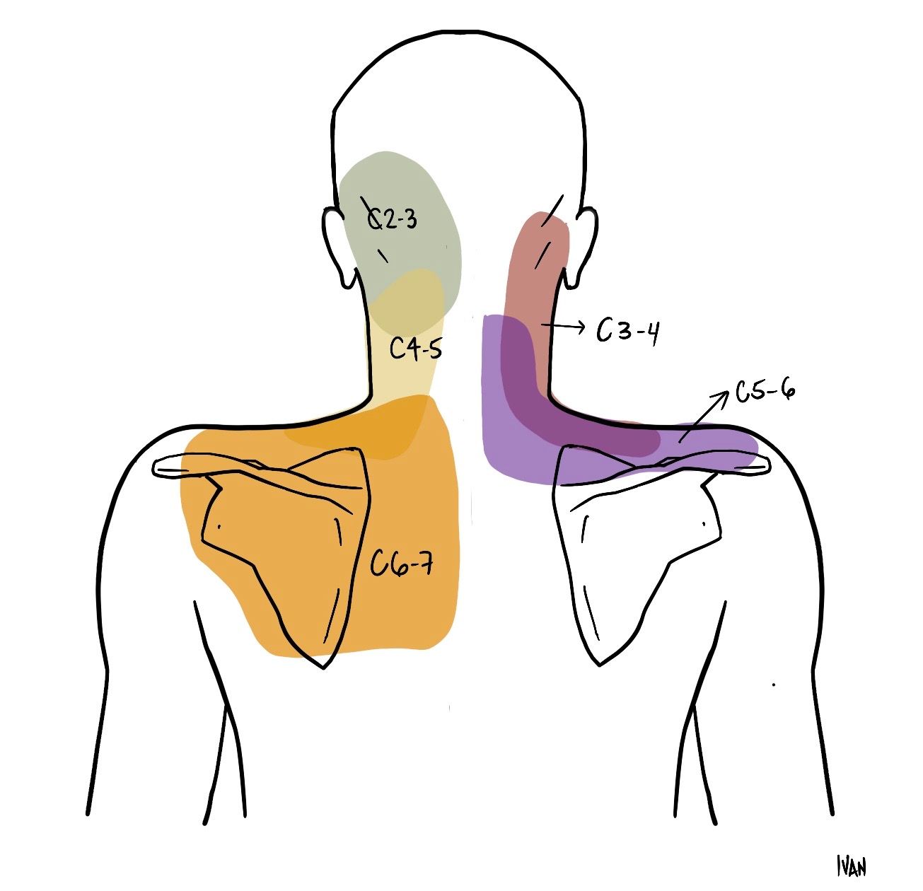 Cervicalgia | Dr. Ivan Rocha