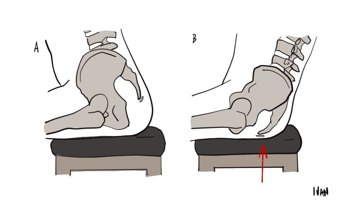 Coccidínia (Dor no Cóccix) | Dr. Ivan Rocha