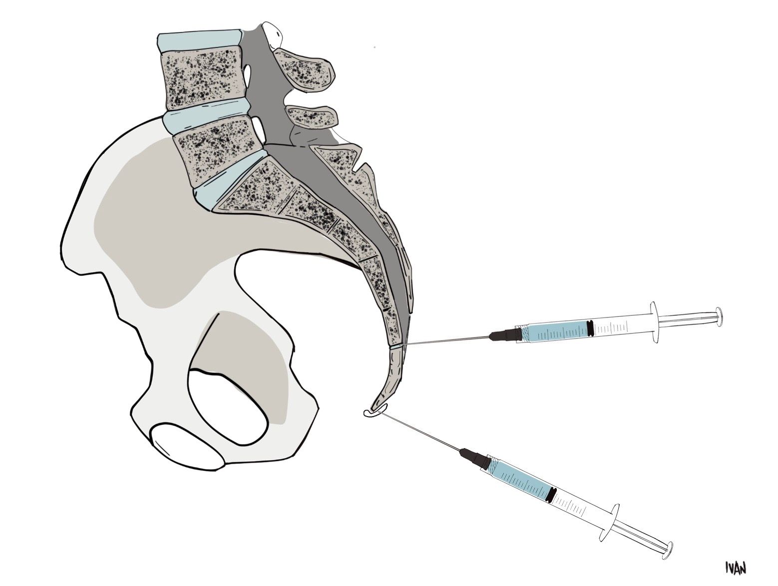Coccidínia (Dor no Cóccix) | Dr. Ivan Rocha