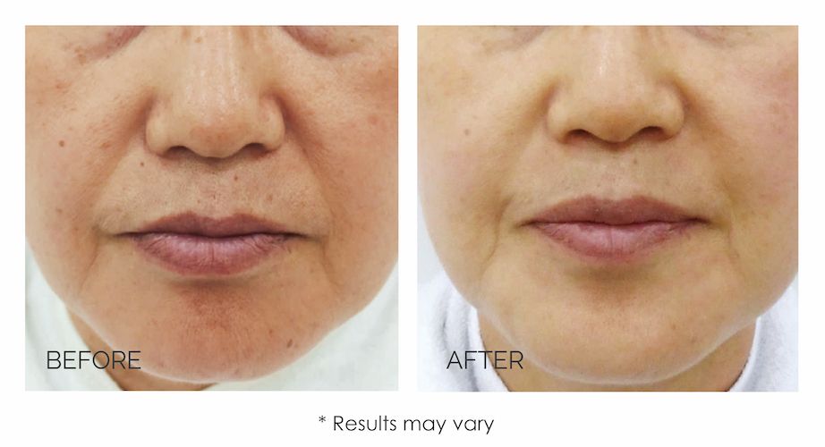 IPL Skin Treatment | Clear Dermatology - Jennifer L. Mueller, MD