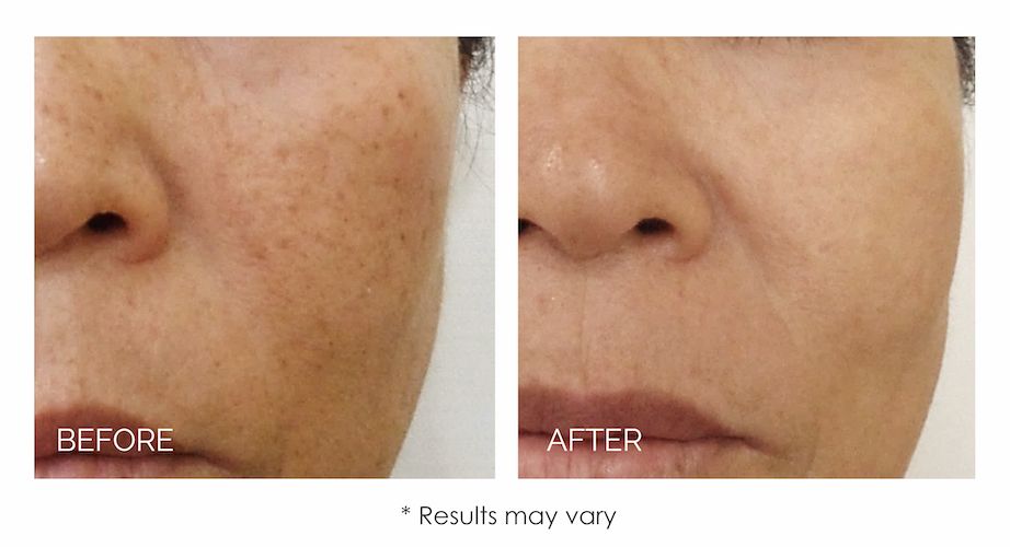 IPL Skin Treatment | Clear Dermatology - Jennifer L. Mueller, MD