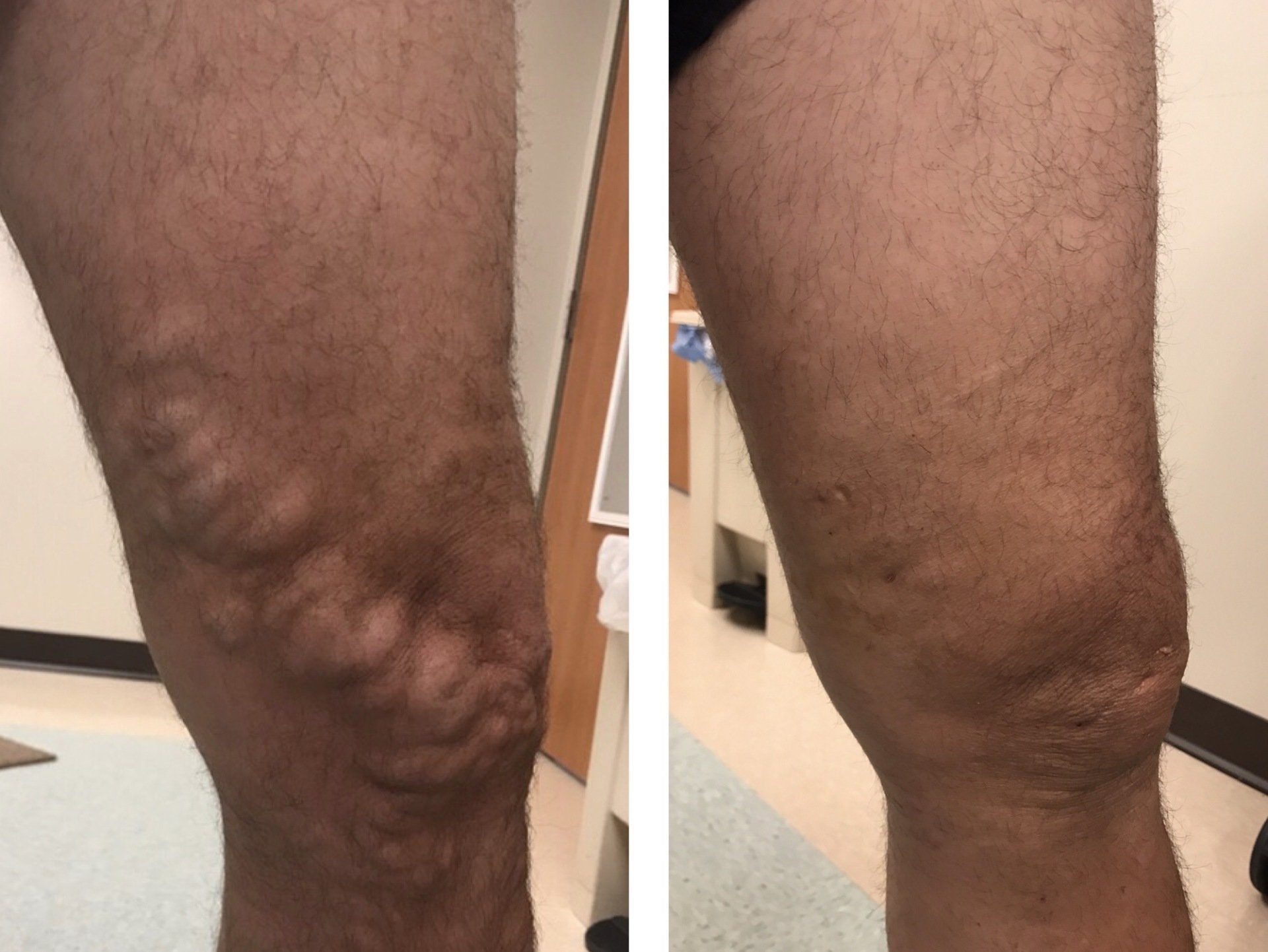 Modern Vein Treatments