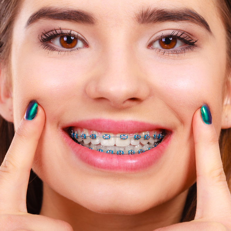 How to Know if You Need Braces