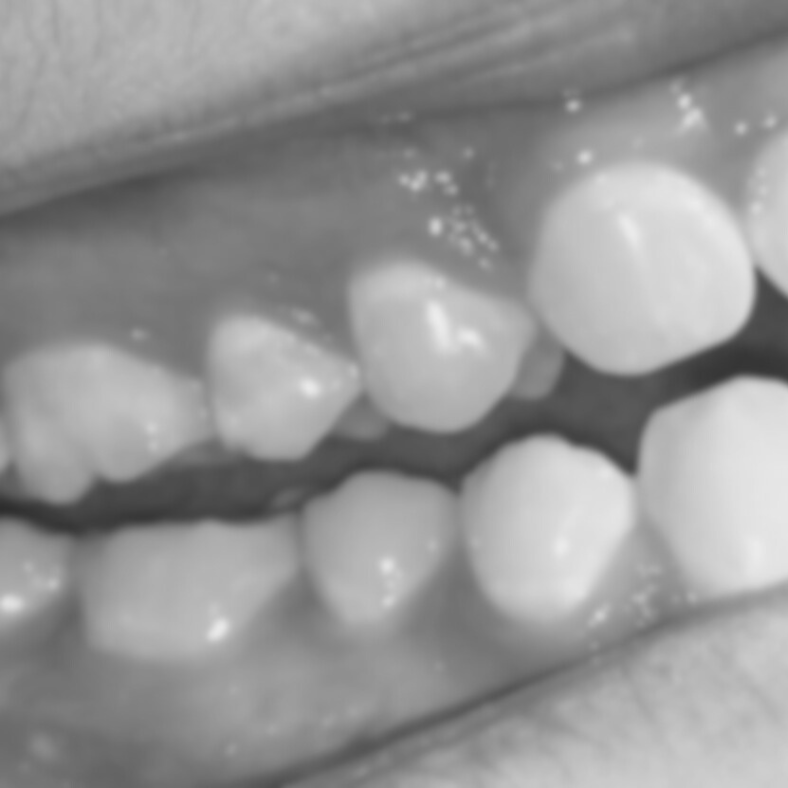 Uneven Pressure Distribution: Tooth Damage in Ankylosed Teeth