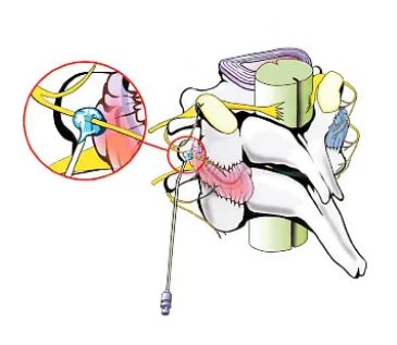 Cervical Medial Branch Block | Pain Consultant of Texas
