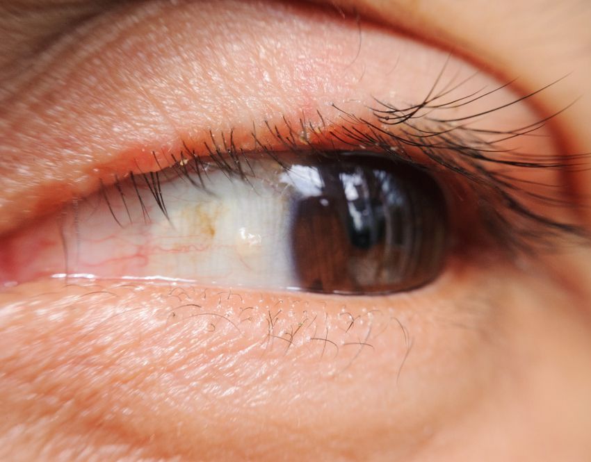 Zest Treatment | BeSpoke Vision