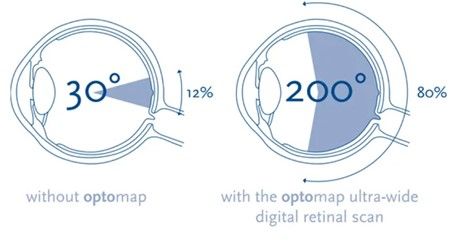Optomap For Retinal Detachment Diagnosis & Treatment: How It Works