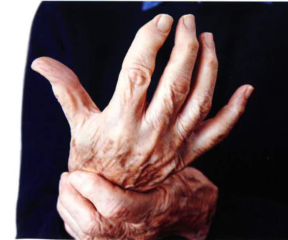 Osteoarthritis