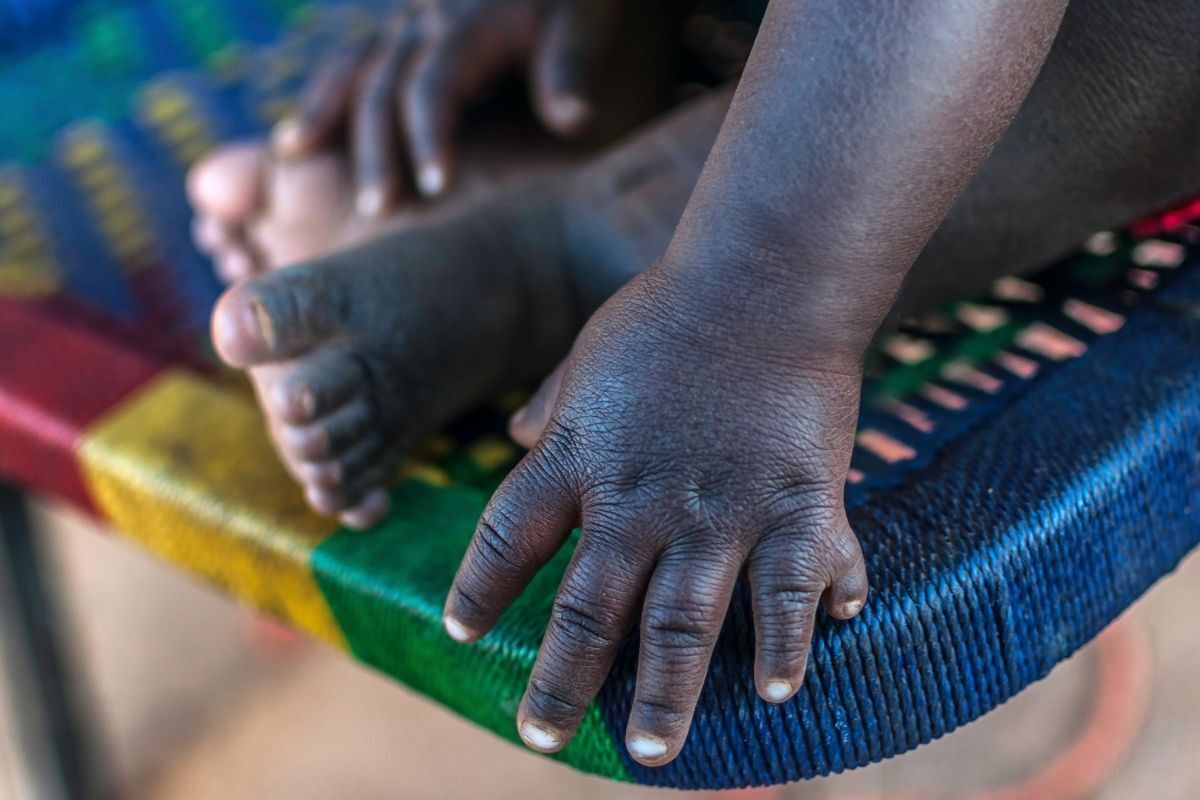 Polidactilia: o que é e como tratar