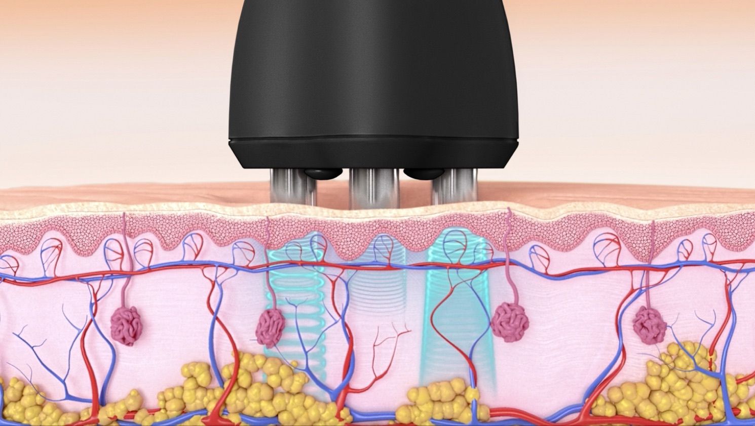 Venus Versa Pro™ | Multifunction Aesthetic Treatment Machine