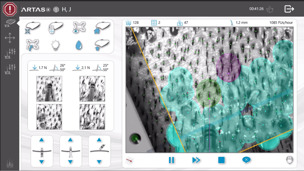 ARTAS® iXi | Robotic Hair Transplant and Restoration Machine | Venus