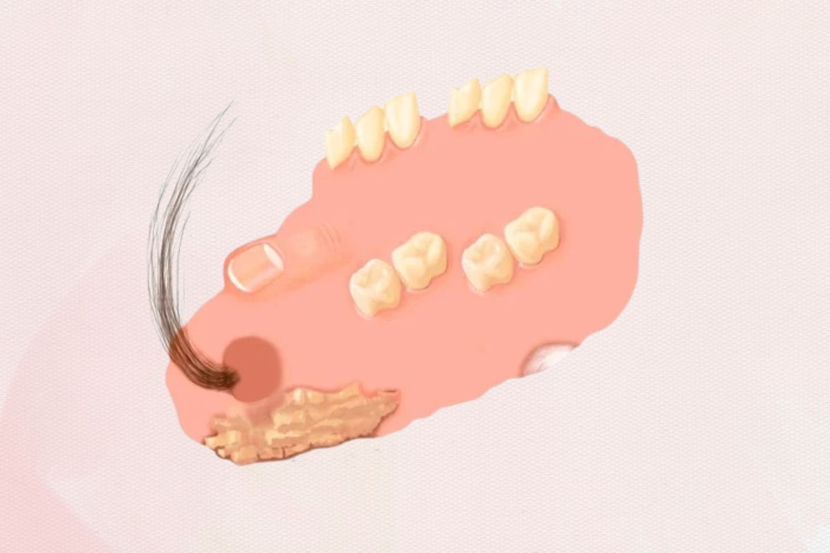 Teratoma de ovário: saiba o que é