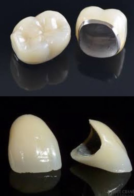Dental Crowns