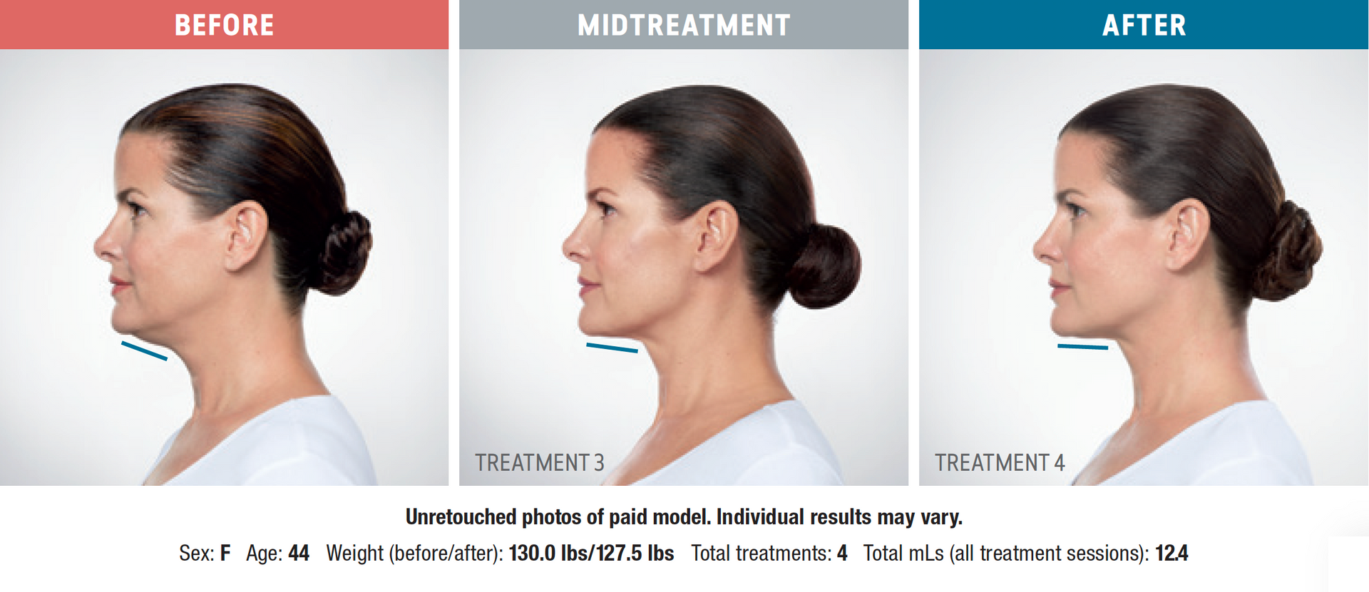 Kybella® - Define Your Jawline | Comprehensive Dermatology of Long Beach