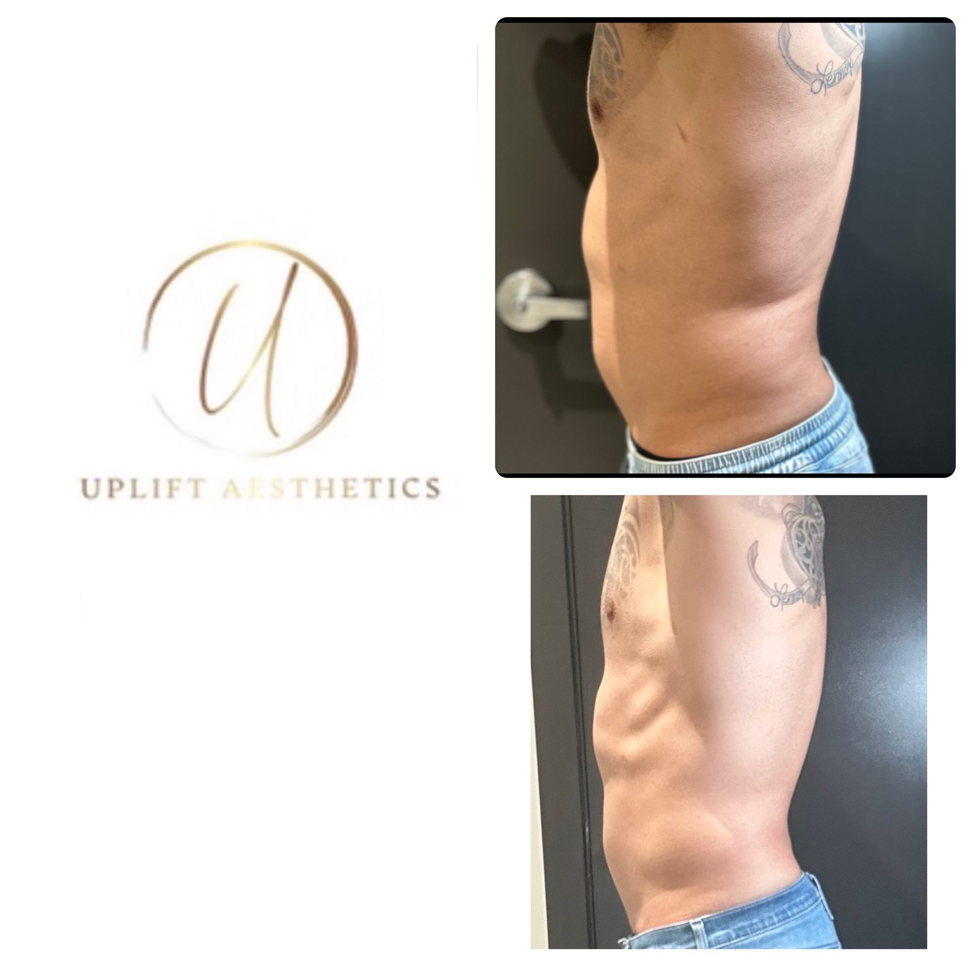 Emsculpt Neo Body Contouring Winnipeg