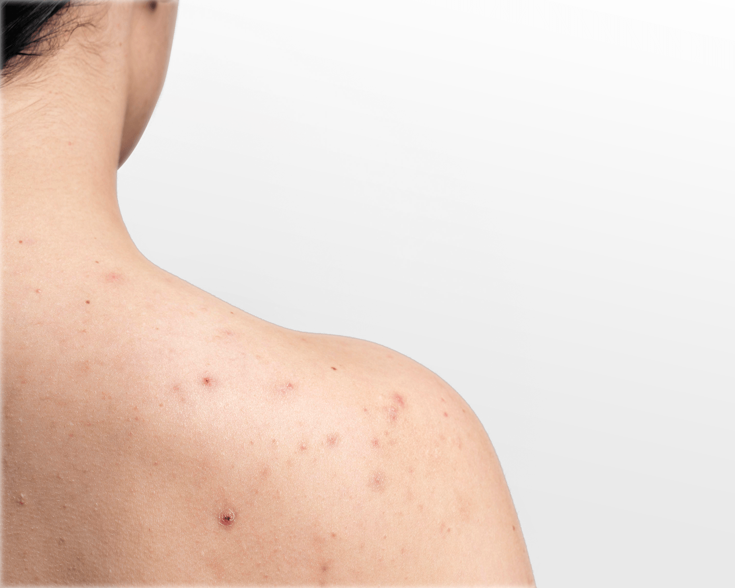 Back Acne Treatment - RegenX Clinic